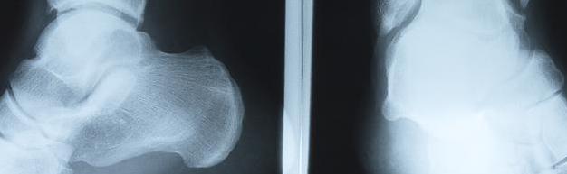 Afectiunile gambei si coapsei