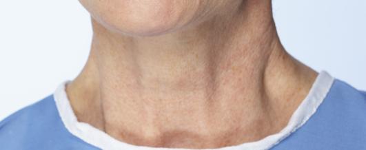 Faringita si amigdalita